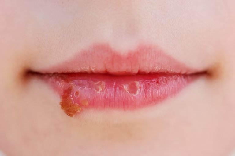 Herpes Labial: O vírus que vai e volta - Trindade Odontologia
